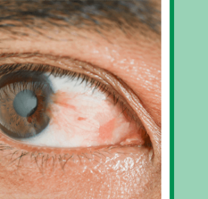Pterygium Symptoms, Diagnosis & Treatment | Benaim Eye, Jupiter